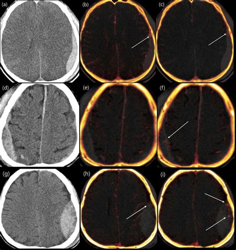 Classification Of Contrast Leakage Patterns Dual Energy Ct Images Download Scientific Diagram