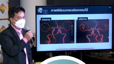 จากเรื่องเล่ V Flow วีโฟลว์ สมุนไพรบำรุงร่างกาย หลอดเลือด