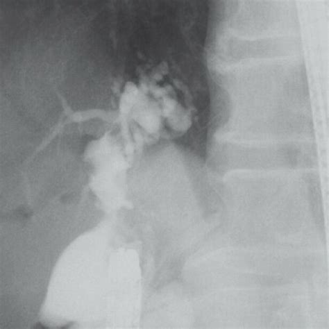 After Stone Removal Cholangiogram Showed That The Stones Were Removed