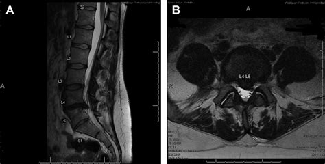 Lumbosacral Transitional Segments Physical Medicine And