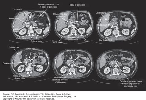 Pancreatic Carcinoma Ct