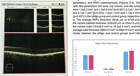 Choroidal Thickness Oct Image Measurement Method Download Scientific Diagram