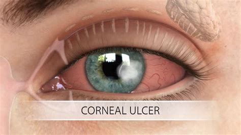 Different Types Of White Spots Under Eyelid And Home Remedies Treatment