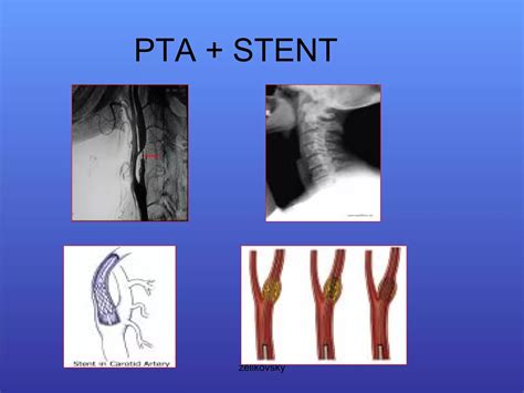 Carotid Endarterectomy Ppt