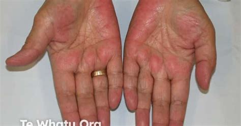 Palmar Erythema Image