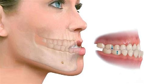 The Cost Of Underbite Braces Treatment In 2024