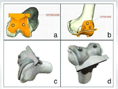 A And B Software Designing Of Patient Specific Instrument Psi Using Download Scientific