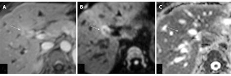 A Case Of Periductal Type Of Hilar Cholangiocarcinoma A Axial Download Scientific Diagram
