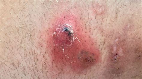 Ingrown Hair Staph Infection