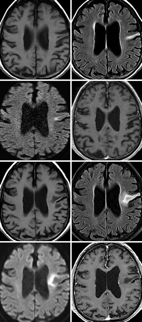Progressive Multifocal Leukoencephalopathy The Neurosurgical Atlas