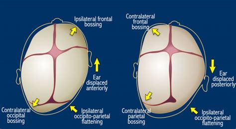 Anterior Plagiocephaly