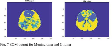 Figure 7 From Brain Tumor Type Detection Using Texture Features In Mr Images Semantic Scholar