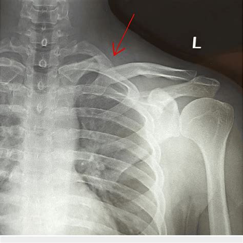 Figure 1 From Mini Fragment Locking Compression Plate Fixation Of A