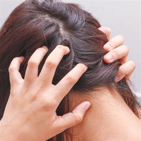 Ringworm Of The Scalp Tinea Capitis Causes Symptoms And 48 Off