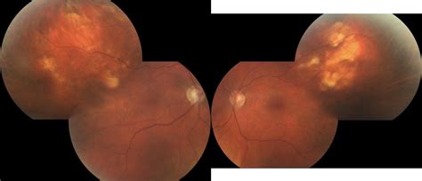 Idiopathic Sclerochoroidal Calcification Optometry And Vision Science