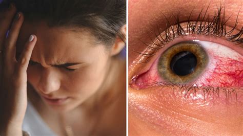 Sintomas De Glaucoma