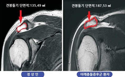 국제성모병원 어깨충돌증후군 새 진단법 개발