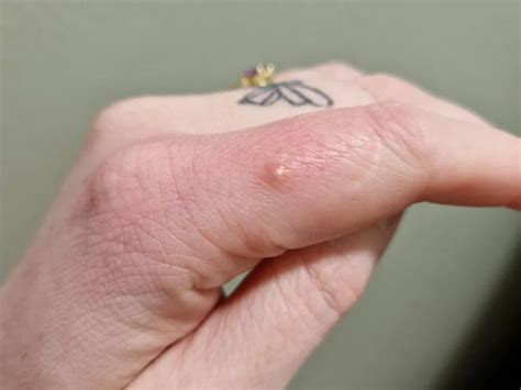 ‘spot On Womans Finger Turned Out To Be False Widow Spider Bite