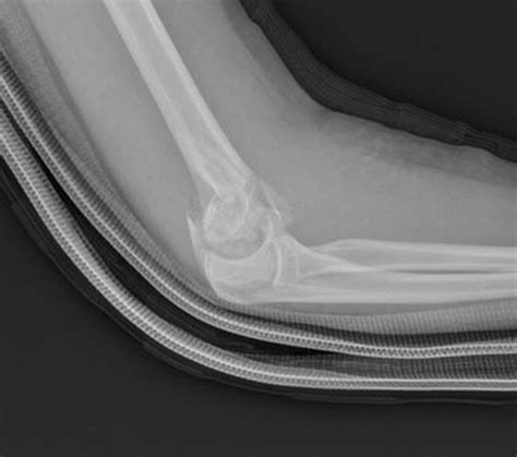 Technique Spotlight Principle Based Internal Fixation Of Distal Humerus Fractures Clinical Tree