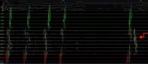 Flutter Auricular Atípico Tardio Após Ablação De Fibrilhação Auricular Revista Portuguesa De