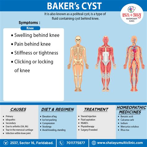 Bakers Cyst Shatayu Multi Speciality Clinic