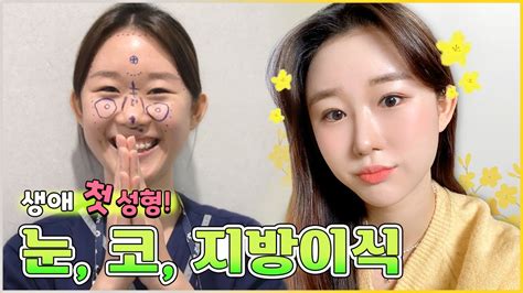 성형브이로그 🌸성형 한달차 후기영상이마지방이식 후기🥰코성형 뒤트임 자연유착까지 🌻 코성형브이로그자연유착눈트임코성형후기지방이식전후성형vlog Youtube