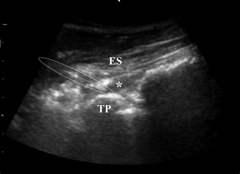 Ultrasound Guided Erector Spinae Plane Esp Block A Novel
