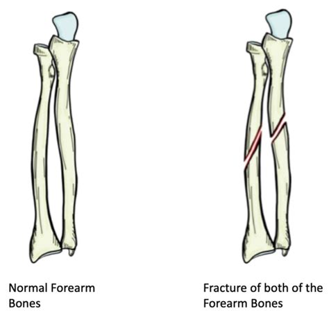 Fracture Of The Radius And Ulna