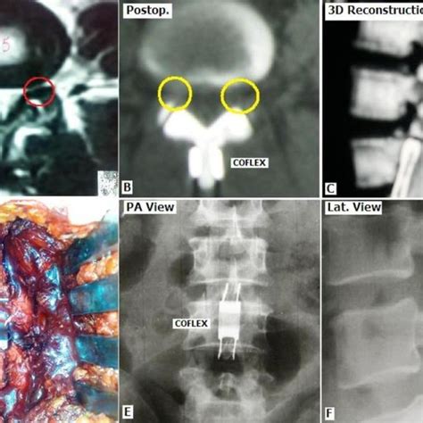 Pdf Coflex Dynamic Interlaminar Interspinous Distraction