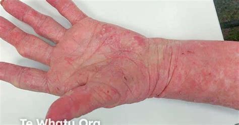 Drug Induced Photosensitivity Image