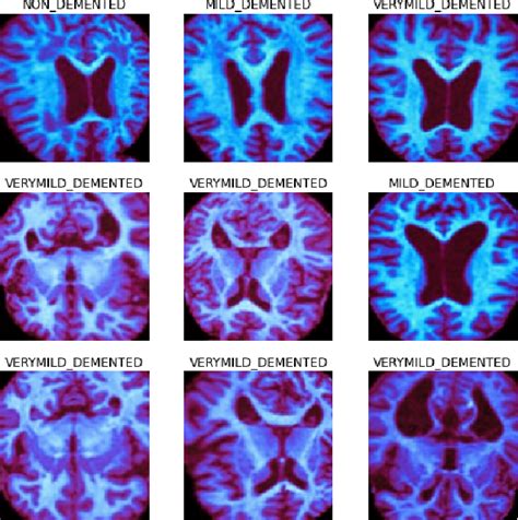Figure 1 From Deep Multi Branch Cnn Architecture For Early Alzheimers