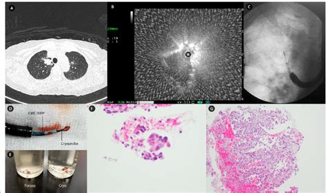Case 1 Solitary Pulmonary Nodule In Apical Segment Of Right Upper Download Scientific Diagram