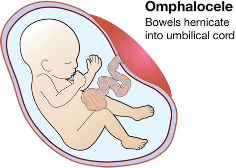 Omphalocele Definition