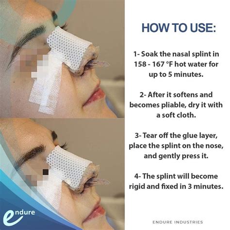 Nasal Fracture Splint Nose Fracture Ent Clinic