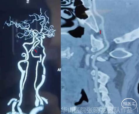 Stent Assisted Coiling Of Left V4 Segment Dissecting Aneurysm 脑医汇 神