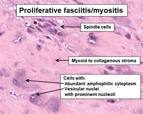 Proliferative Fasciitis And Proliferative Myositis Wikiwand