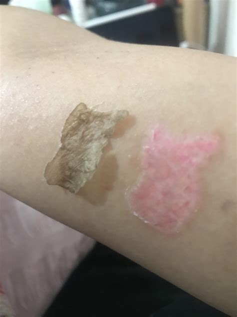 Red Tattoo Flaking Causes Prevention And Care Tips