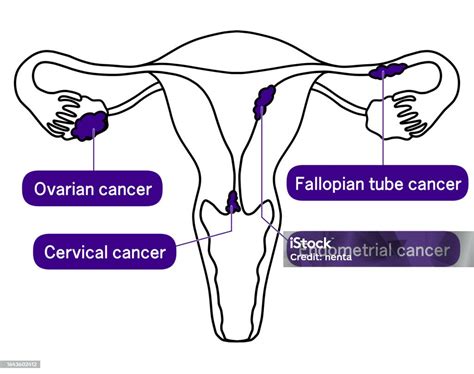 Simple Illustrations Of Cervical Cancer Endometrial Cancer Ovarian