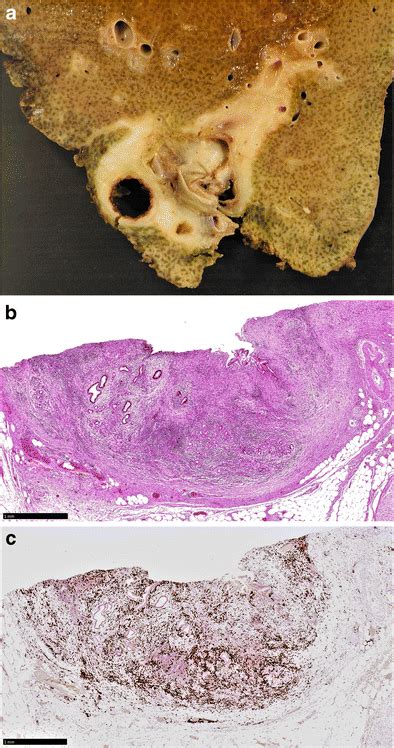 IgG4 Related Sclerosing Cholangitis IgG4 Related SC A Cut Section Download Scientific