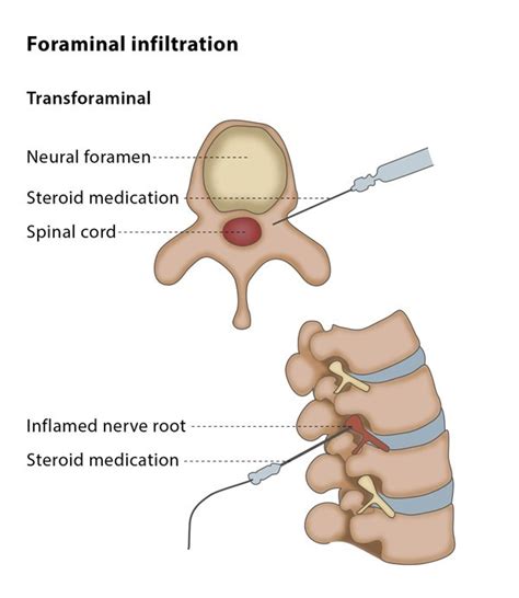Local Infiltration Injection At Debra Lunsford Blog