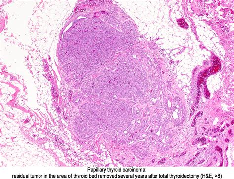 Pathology Outlines Papillary Thyroid Carcinoma Overview