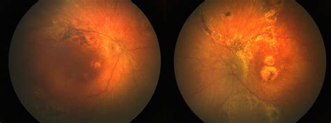Lymphocytic Choriomeningitis Virus Eyewiki