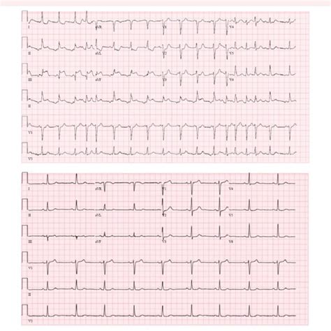Pre And Post Catheterization Ekg Ekg Before Top And After Bottom