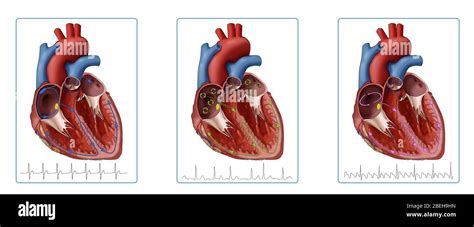 Heart AFib And Atrial Flutter Illustration Stock Photo Alamy