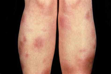 Pyoderma Vegetans And Vasculitis