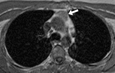 Thymic Lymphoid Hyperplasia Ct At Brendan Gates Blog