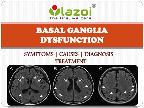 Ppt Basal Ganglia Disease Causes Symptoms Treatment And Diagnosis
