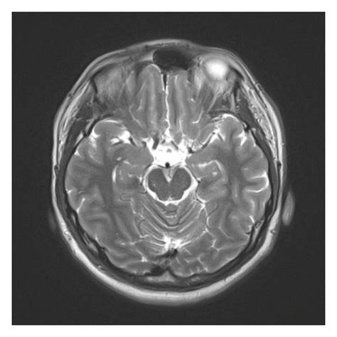 Subjective Denoising Results Of Mri 2 In Different Ways A Original