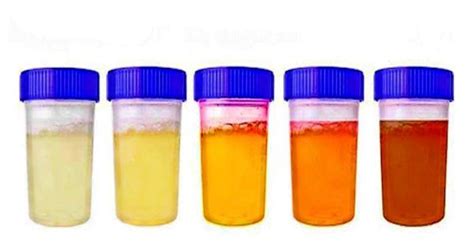 Колір сечі може говорити про ваше здоровя