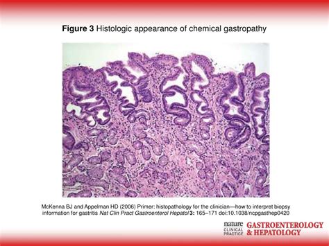 Ppt Figure 3 Histologic Appearance Of Chemical Gastropathy Powerpoint